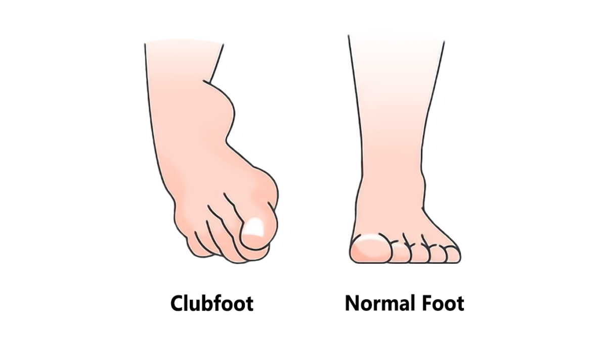 Varus du pied : causes, symptômes et traitements efficaces | Clinique ...
